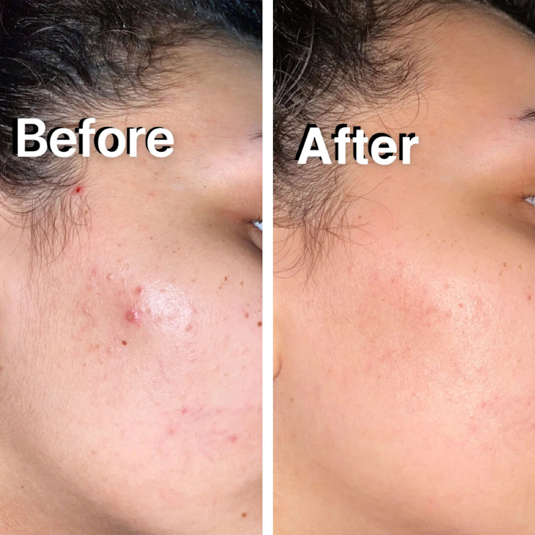 Acne Spot Corrector Gel - Fade ance & dark spot in just one day